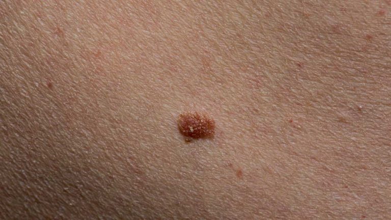 Neoplasm of Uncertain Behavior: What It Means and How It's Treated ...