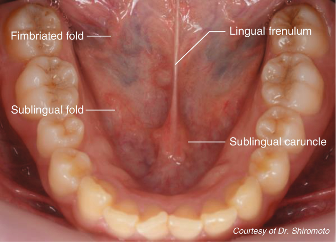 Fimbriated Fold of Tongue: An Overview of its Anatomy and Function ...